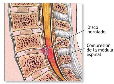 Off topic : Hernia discal L5-S1 | inzitan blog